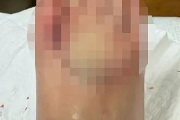 Horror images of 'shark bite' wounds after four savaged as urgent ...