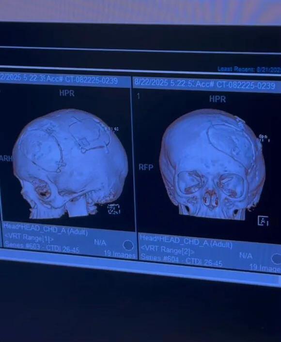 Parents speak out after Texas middle schooler suffers skull fracture in ...