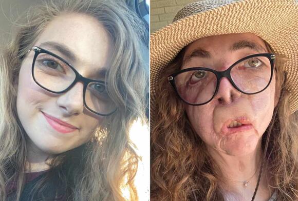 Woman Shares Raw Update Four Years After Dog Attack Tore Off Her Face ...