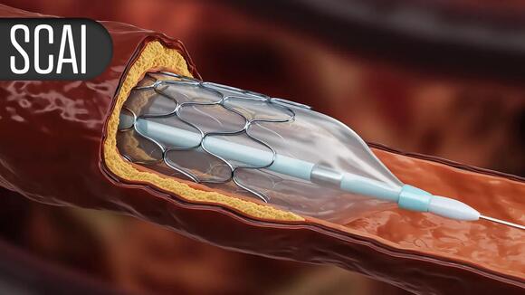 GLP-1 Drugs Make Promising Debut in TAVR, Carotid Artery Stenting ...