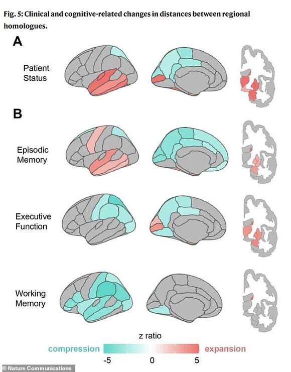The shape of your brain could predict if you will develop dementia ...
