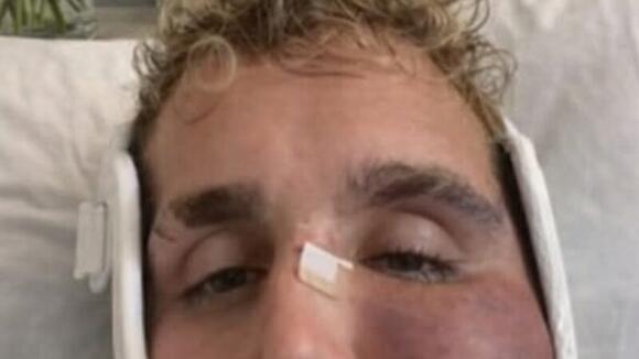 Shocking Images Of Jake Paul’s Swollen Face Leak Online After Anthony ...