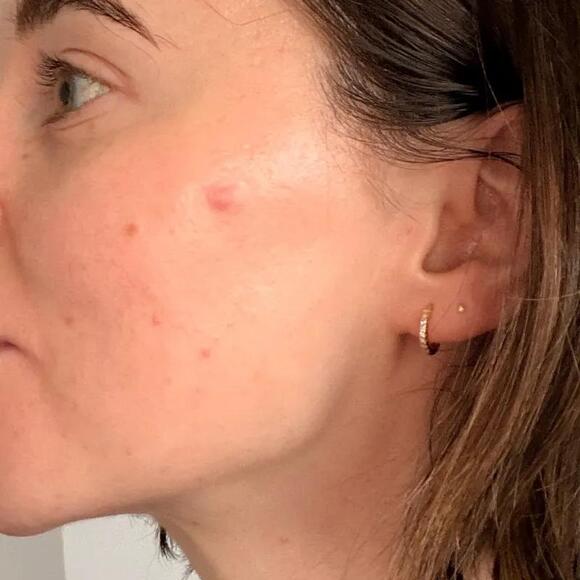 I Tested the Internet’s Most-Loved Spot Patches—Here’s Why They’re ...