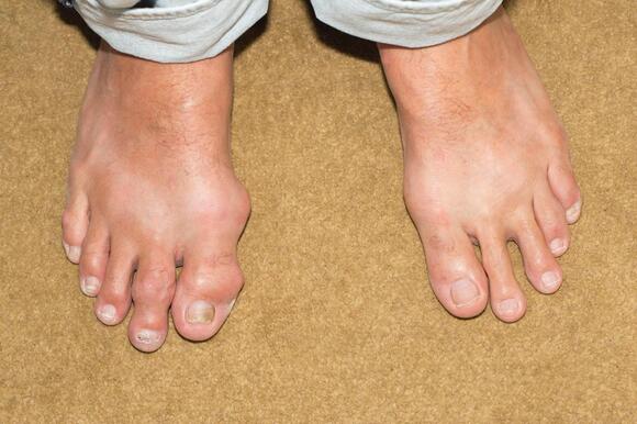 What is gout – and what are the early warning signs to look out for ...