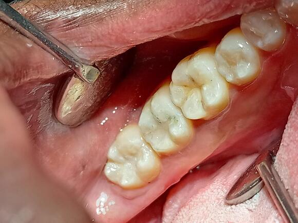 The Missing Wisdom Teeth Mystery: Why Some People Are Evolving Without ...