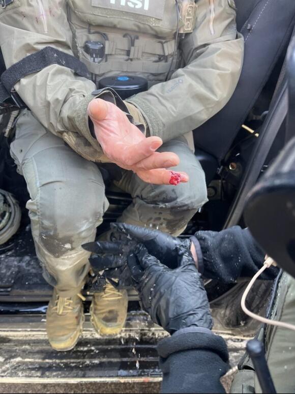 DHS Posts Gross Picture of Agent’s Finger Allegedly Bitten Off by Anti ...