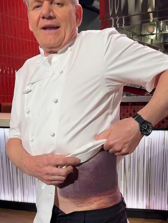 ‘I’m lucky to be here’: Gordon Ramsay suffers horrific bruises in ...