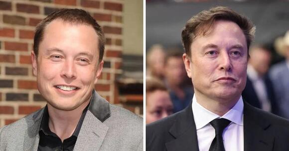 Radar Reveals 12 Celebrities Who Had Hair Transplants Including Elon ...