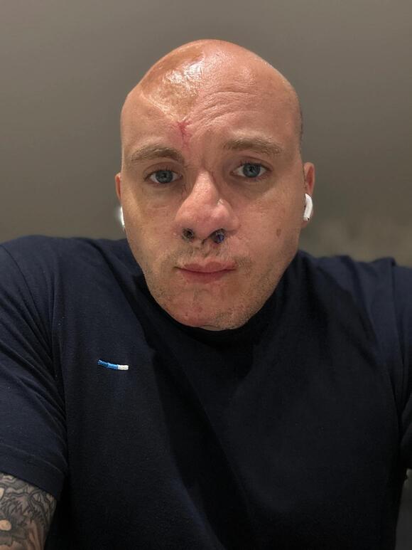 Man has nose ripped off by dog, uses his own ribs to replace it - NewsBreak