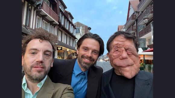 What happened to Adam Pearson from A Different Man? Actor's condition ...