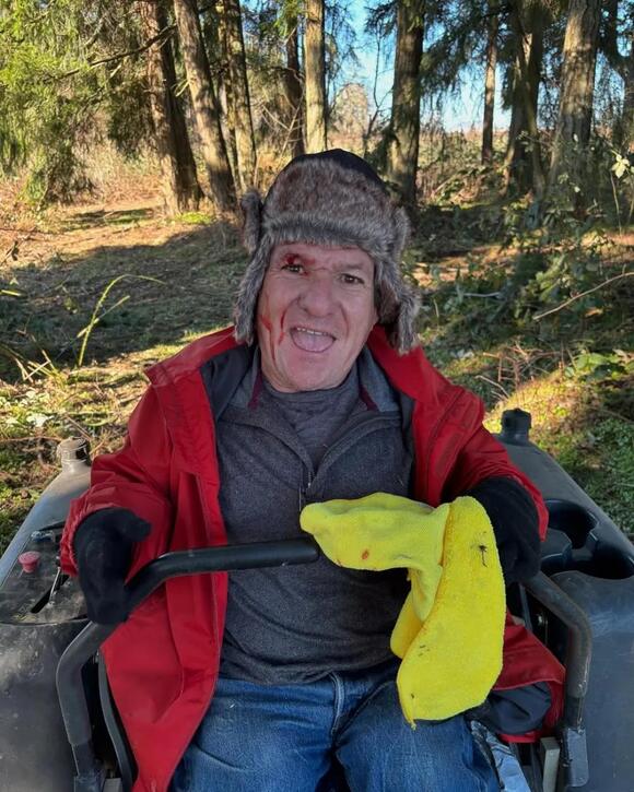 LPBW’s Matt Roloff Shares Photo of Bloody Face After Accident While ...