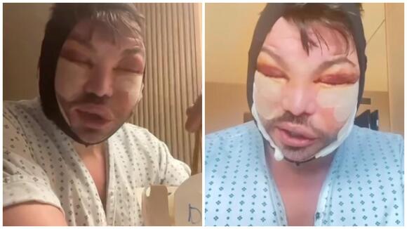 Reality Star Debuts New Face After Abusing Fillers for 10 Years - NewsBreak