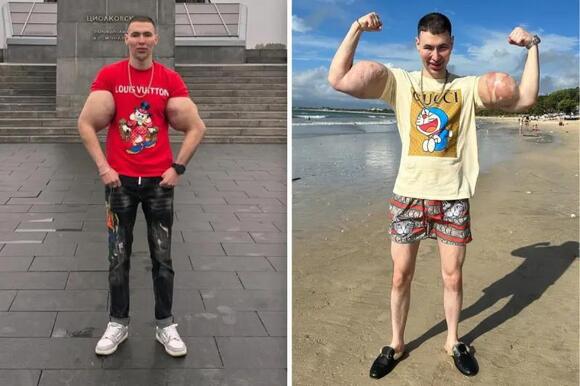 "Russian Popeye" who injected oil into his biceps for years again faces ...