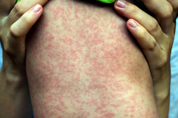 CDC sends team to Chicago to help contain measles outbreak at migrant ...