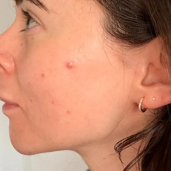 I Tested the Internet’s Most-Loved Spot Patches—Here’s Why They’re ...