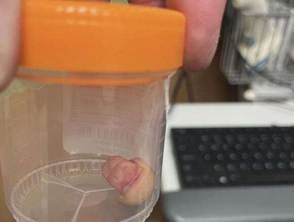DHS Posts Gross Picture of Agent’s Finger Allegedly Bitten Off by Anti ...