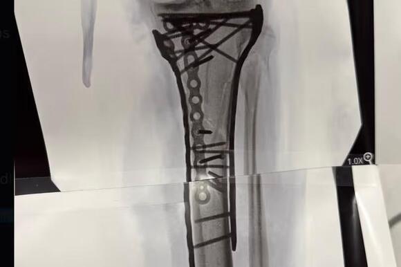 Lindsey Vonn shares horrifying X-ray after sickening crash had her ...