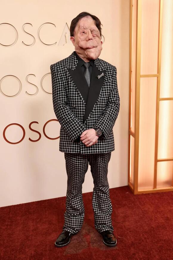 British Actor Adam Pearson, Who Lives with Neurofibromatosis, Arrived ...