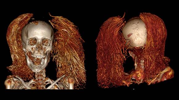 'Screaming Woman' mummy suffered a painful death in ancient Egypt ...