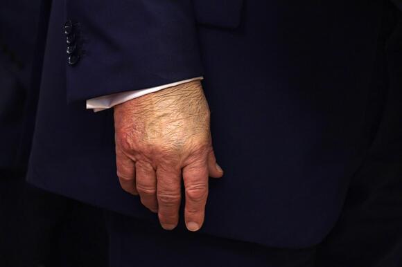 Trump, 79, Cakes Bruised Hand in Makeup After Vanishing for Days ...