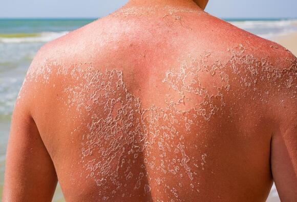Sunburn or sun poisoning? How to tell if you’ve gotten too much sun