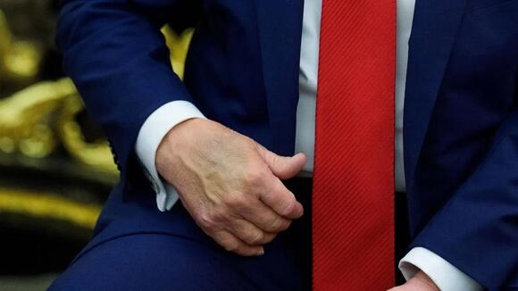 Donald Trump's Bandages and Bruises Spark Health Speculation: What ...
