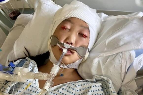Girl, 14, Has Face Separated from Skull in Rare Surgery. Then, She ...