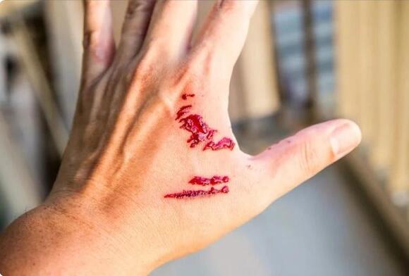 Rabid Bats Warnings Issued After Residents Attacked In New York - NewsBreak