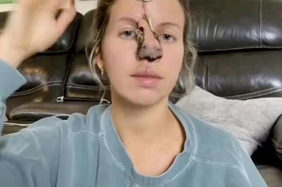 Woman shares horrific injuries after beloved dog of 11 years bites nose ...