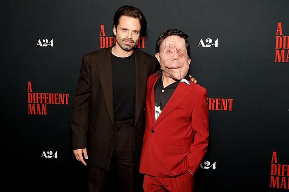 British Actor Adam Pearson, Who Lives with Neurofibromatosis, Arrived ...