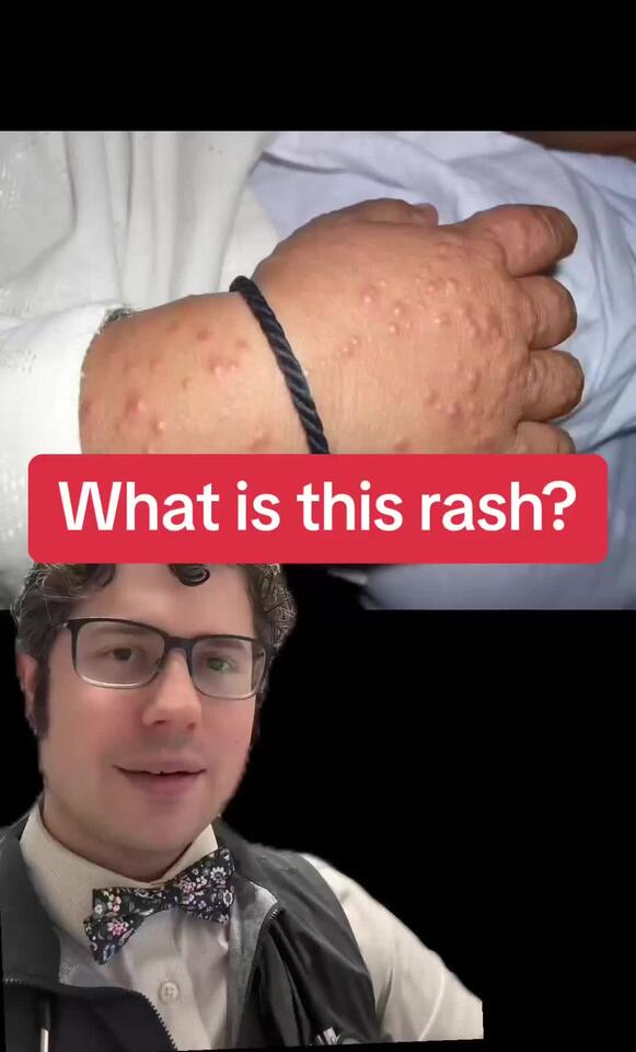 What is this rash What is Gianotti Crosti syndrome What is papular ...