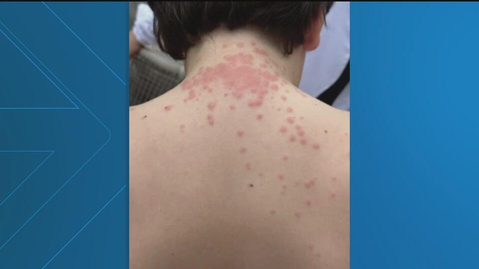 Family sues Delta, KLM, claiming their flight was infested with bed ...