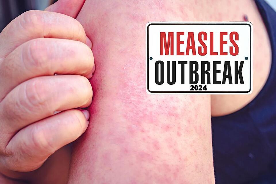 Measles Outbreak Across 15 States Including Indiana: Everything You ...
