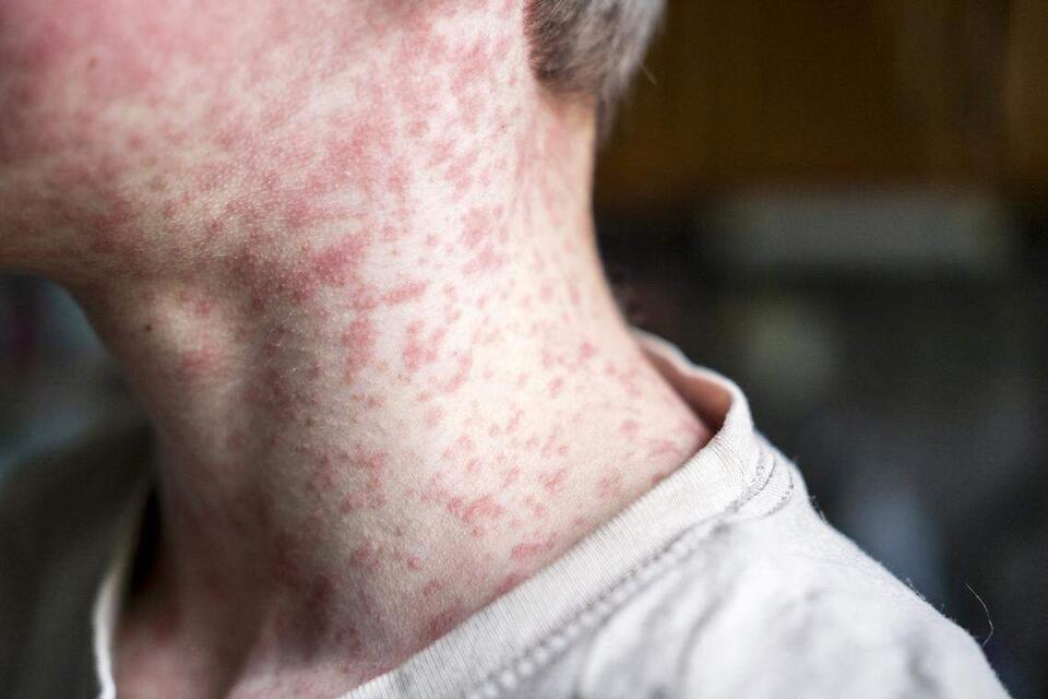 Health officials report second confirmed case of measles in Central KY ...