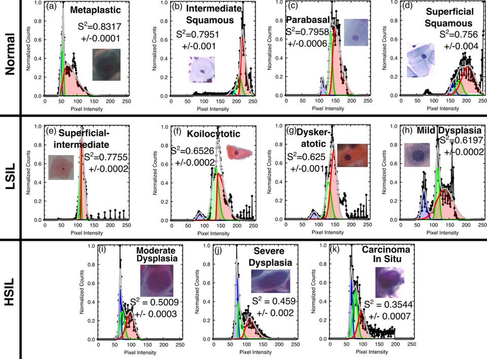Diagnostic Accuracy of Entropy Based Image Analysis of Cervical ...