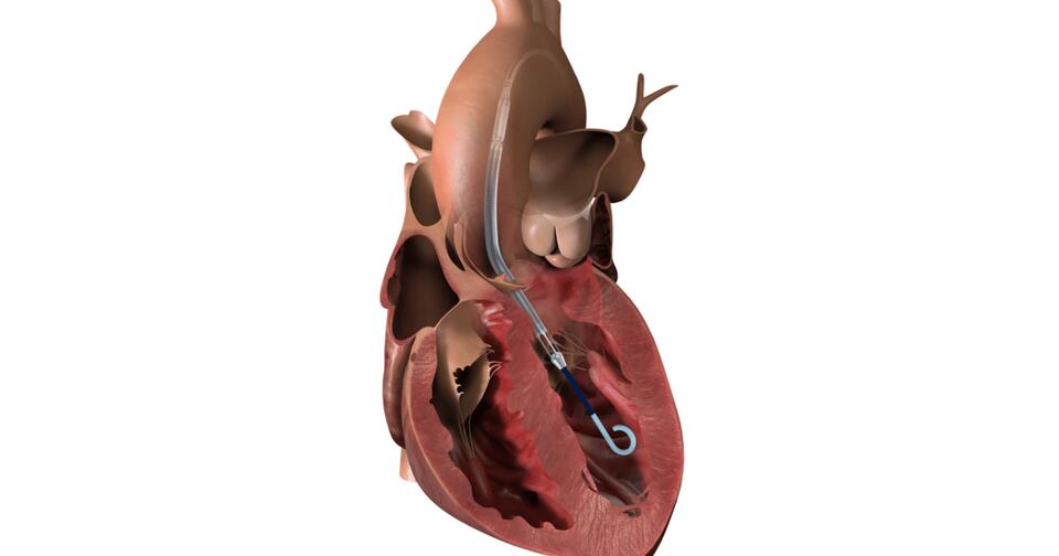 J&J Recalls Impella CP Heart Pumps After Design Flaw Linked to Death ...