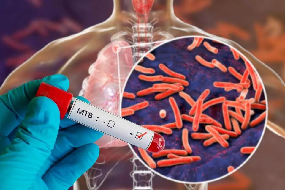 Is Tuberculosis Making a Comeback? What You Need to Know in Indiana and ...