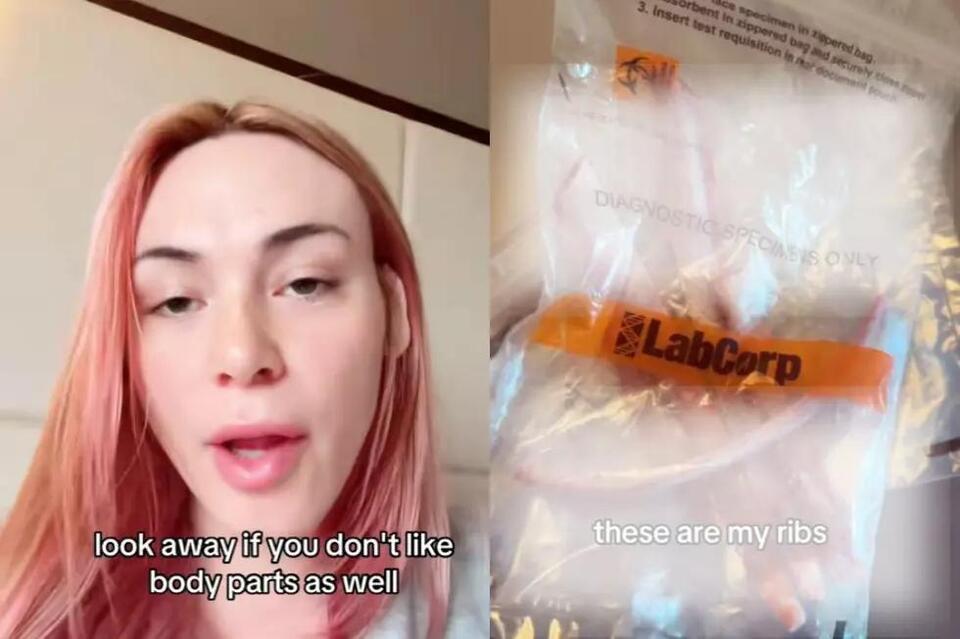 Influencer Removes Six Ribs for Smaller Waist, Turns Bones Into Crown ...