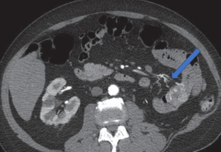Arteriovenous Malformation of the Jejunum, Causing Massive ...