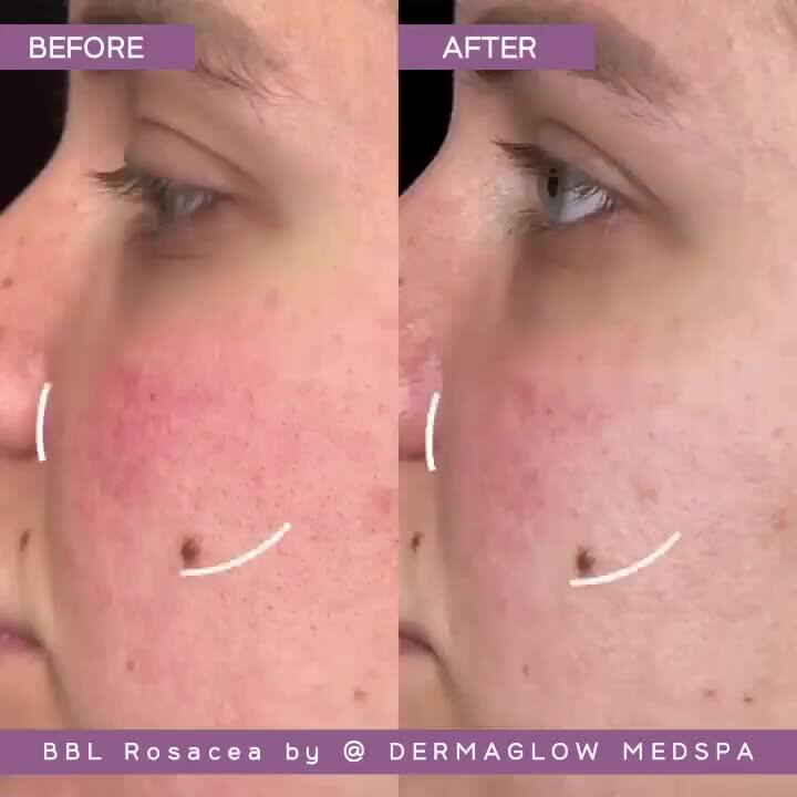 Take a look at the reduction in redness after just 1 BBL treatment for ...
