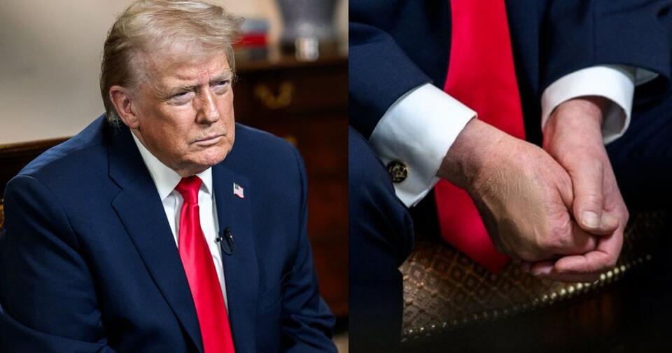 Trump’s Bruised Hands Return to Spotlight After Fox News Interview ...