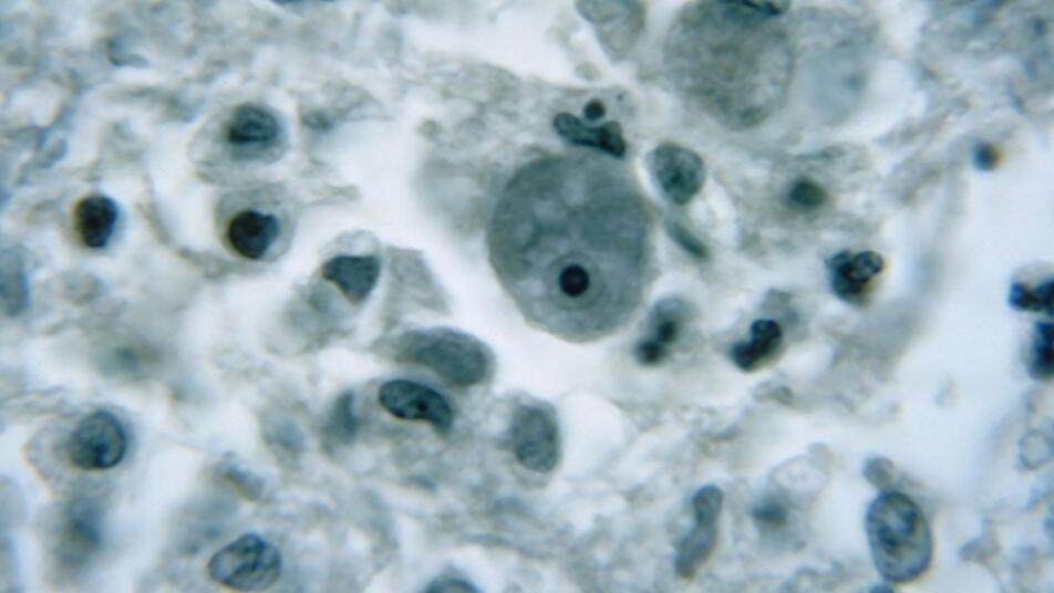 One Dead From Brain-Eating Parasite at a Texas Campground. How to Stay ...