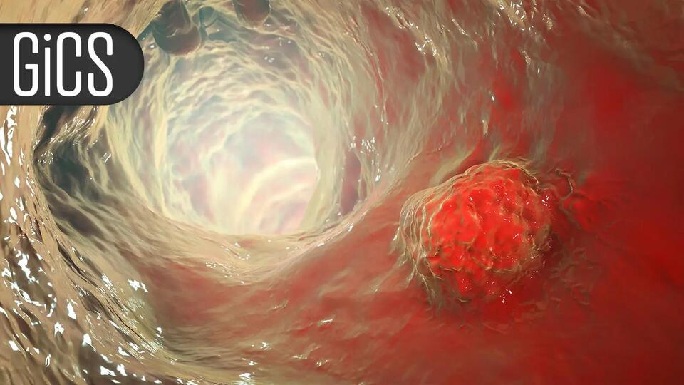 Targeted Drug for Advanced Pancreatic Cancer Sparks Early Enthusiasm ...