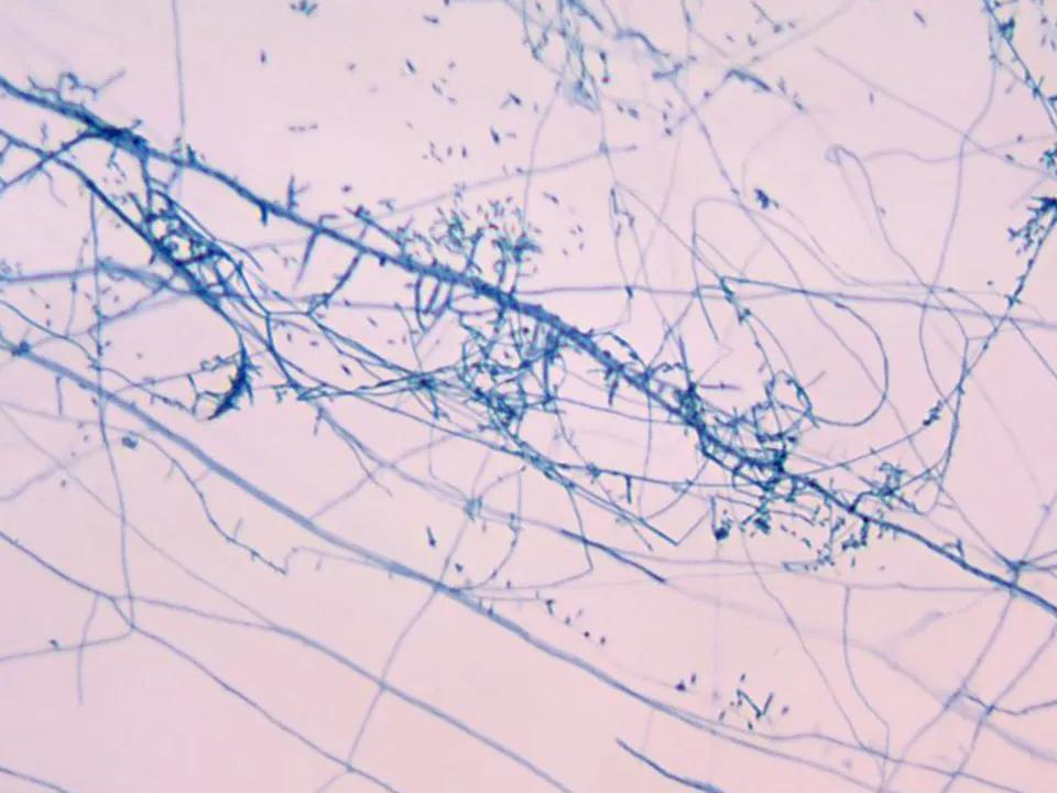 1st Case Of Sexually Transmitted Form Of Ringworm Reported In Us