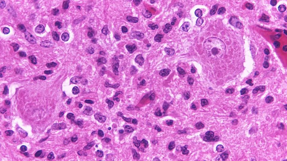 Michigan man dies from rabies-infected kidney transplant, CDC says ...