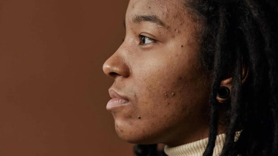 Why you should never pop a pimple in the 'triangle of death' on your ...