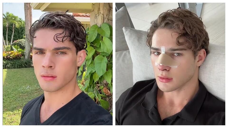 Looksmaxxing Influencer Clavicular's Nose Job Reveal Draws Brutal ...