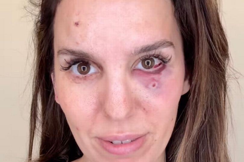 Ex Disney star is shot multiple times in the face while celebrating ...