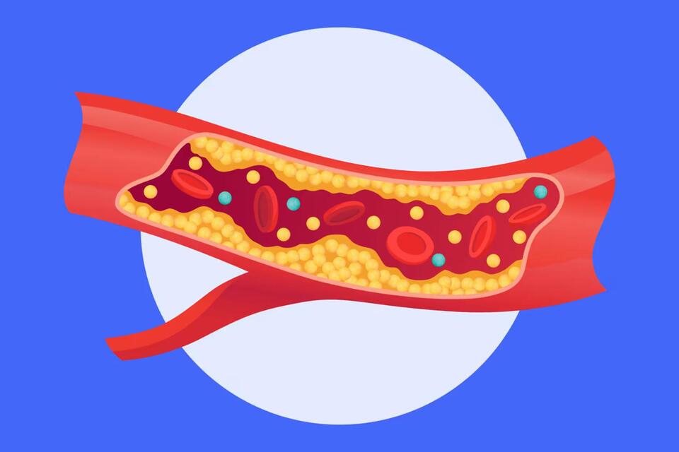 How High LDL Affects Your Heart: A Visual Guide - NewsBreak