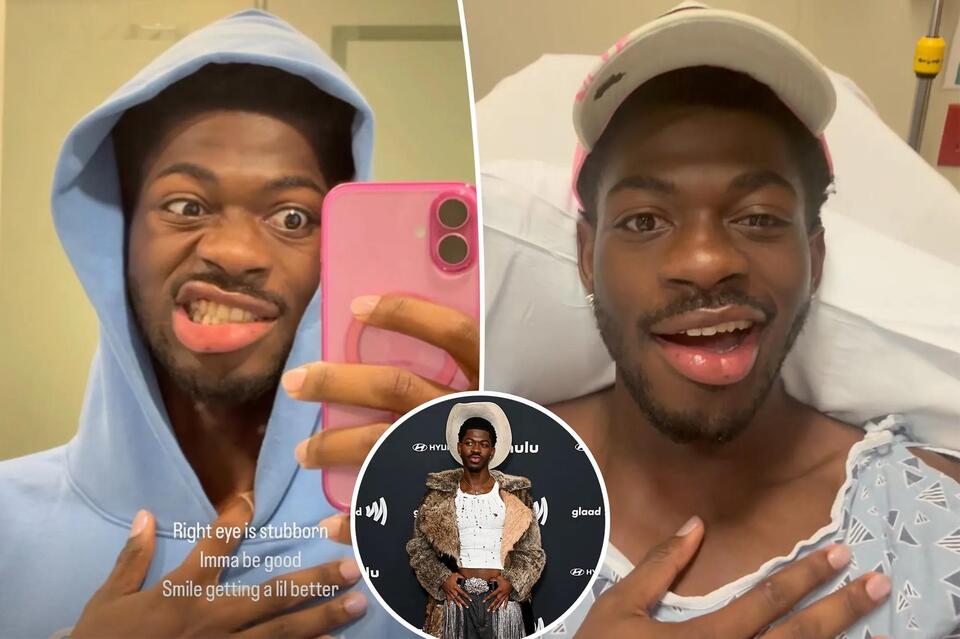 What is Bell’s palsy? All about Lil Nas X’s condition that paralyzed ...